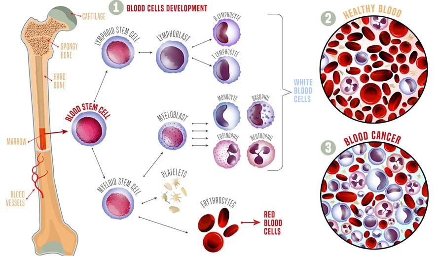 Bone marrow transplant in Australia - Bone marrow Surgery AU